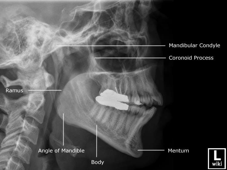 Mandible x-rays - Don't Forget the Bubbles