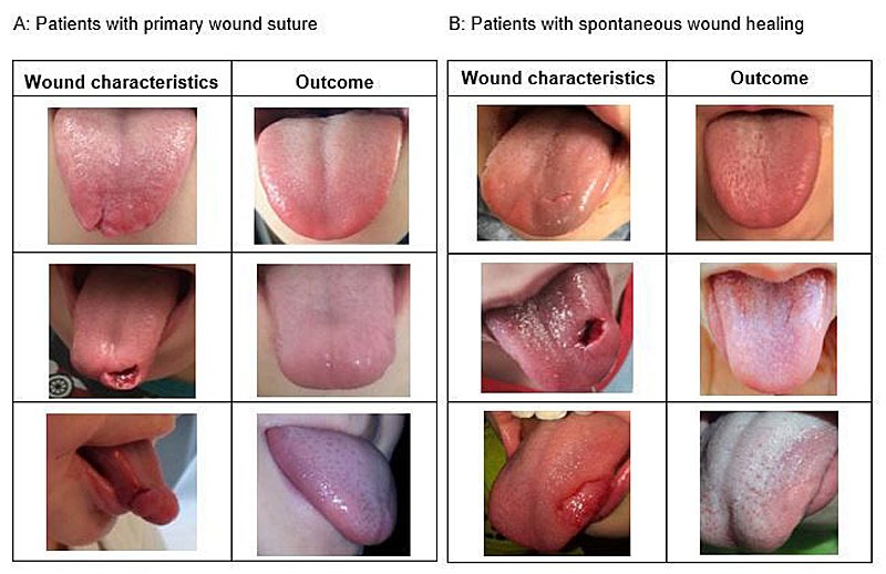 Tongue Lacerations Don t Forget The Bubbles tongue-lacerations-don-t-forget-the-bubbles