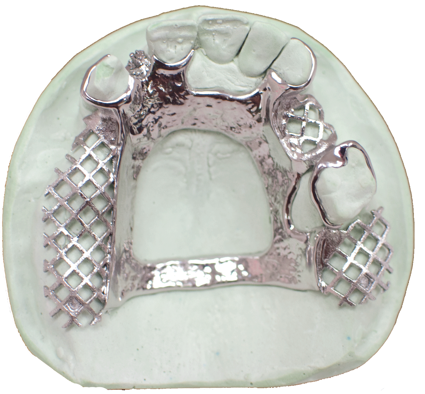 Cast Frame Partials – Dental Prosthetic Services