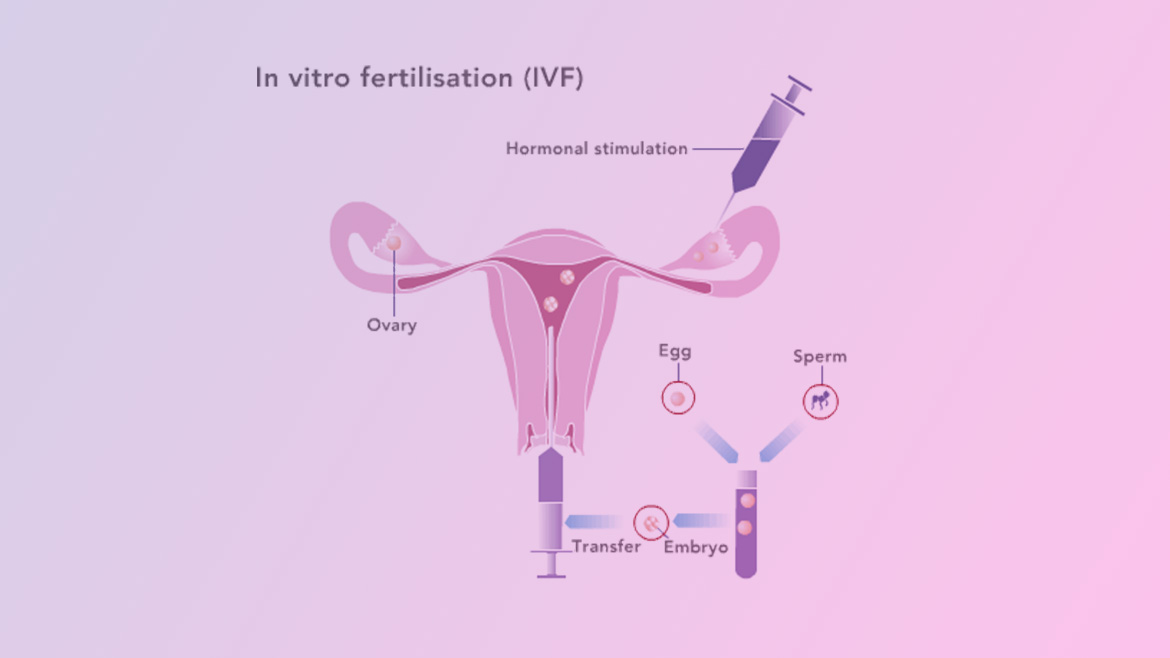 IVF ( In Vitro Fertilization or Test Tube Baby) – Dr. Anindita Singh
