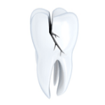 Sensitive & Cracked Teeth - Barta-Sima Dental Care