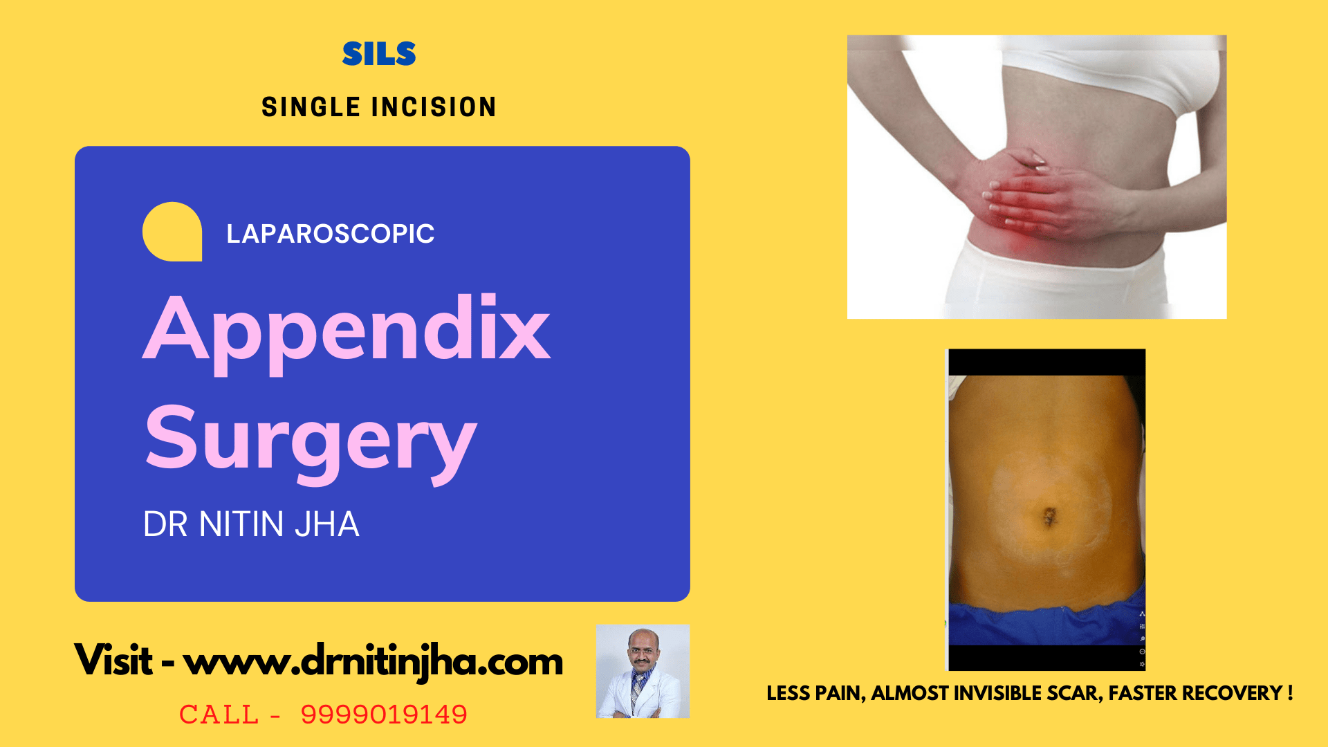 appendicitis treatment in noida BEST , NEW , 100% HONEST OPINION
