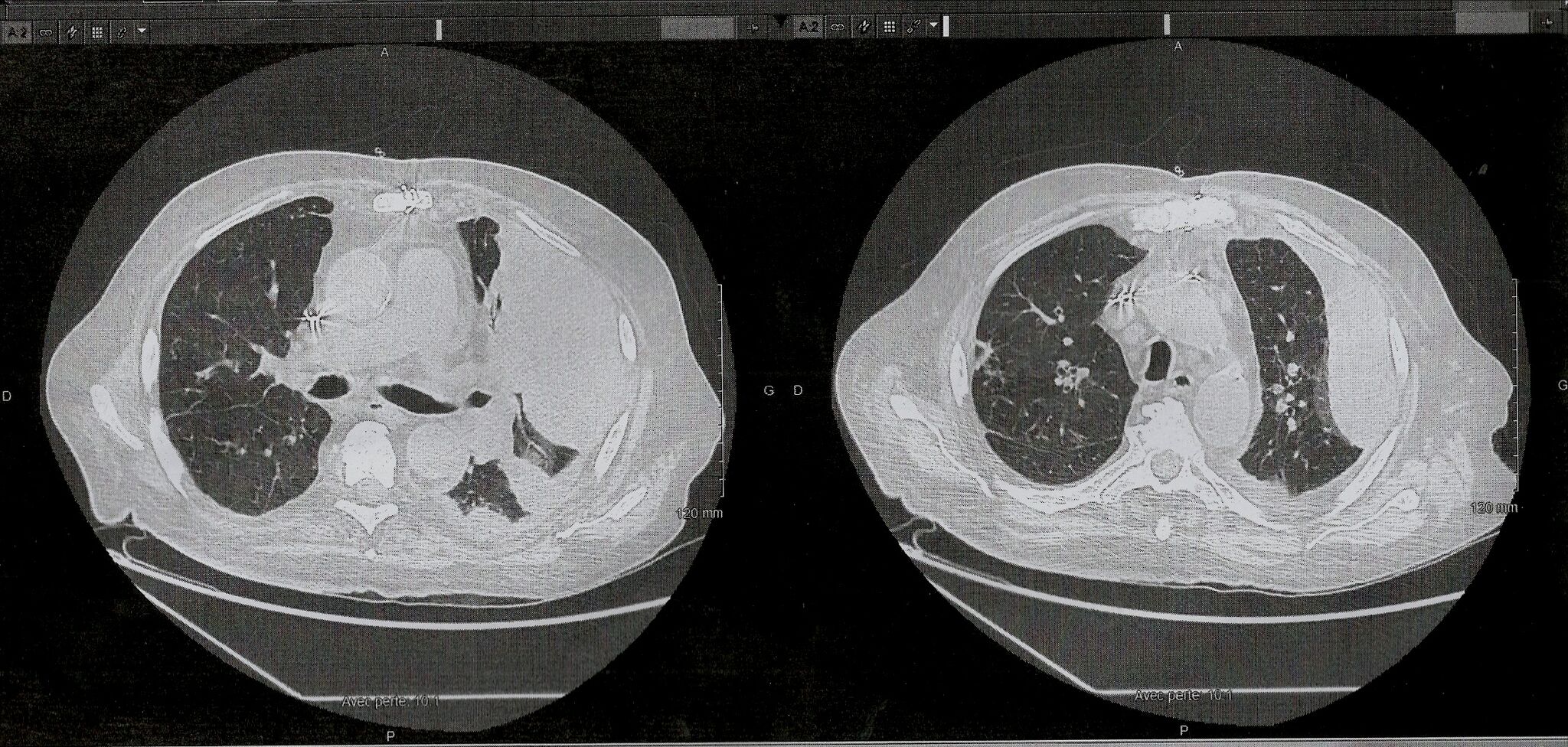 Pleurésie enkystée originale permettant de visualiser le cœur – Echo ...