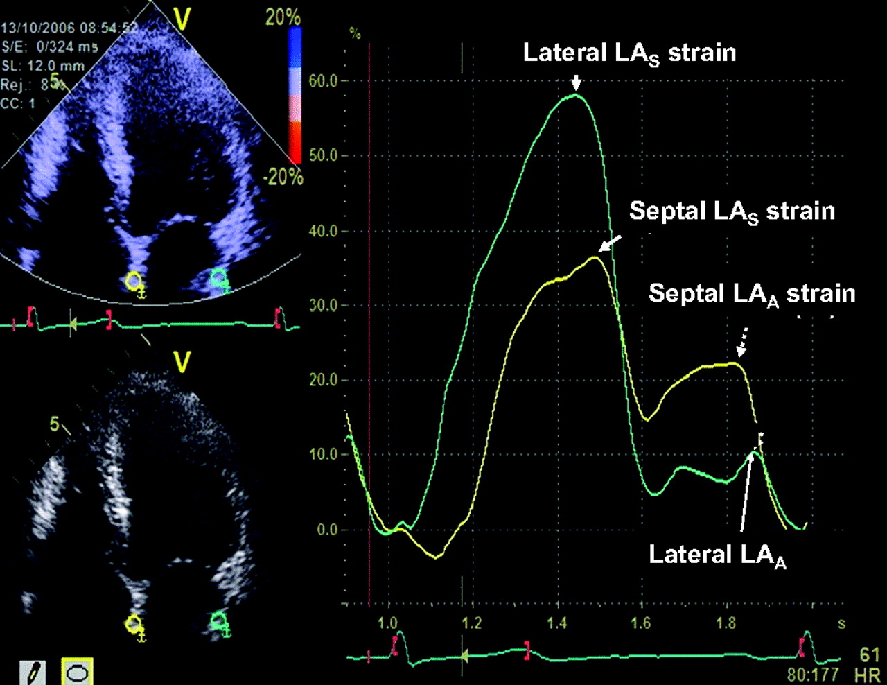 Função do átrio esquerdo na ICD. - EchoTalk Echocardiography