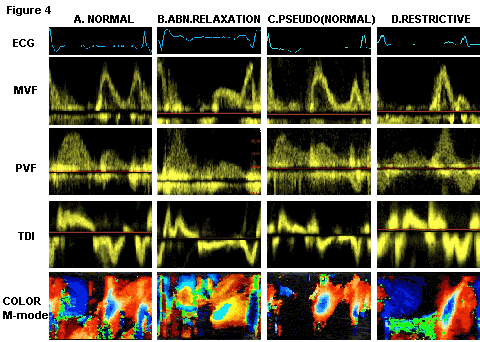 Disfunção diastólica: Vale a pena acompanhar. - EchoTalk Echocardiography