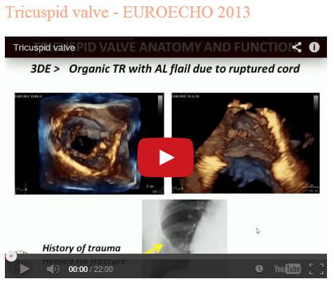 Tricuspid valve – EUROECHO 2013 - EchoTalk Echocardiography
