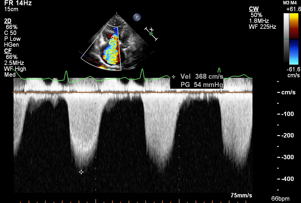 Novo(?) método para avaliar a pressão pulmonar. – EchoTalk