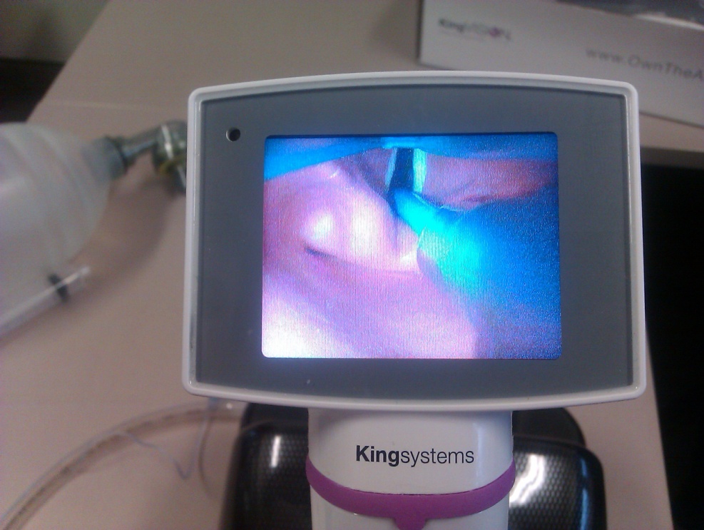 Brief Review of the King Vision Video Laryngoscope