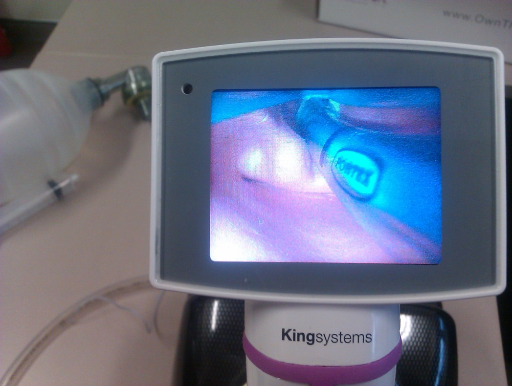 Brief Review of the King Vision Video Laryngoscope