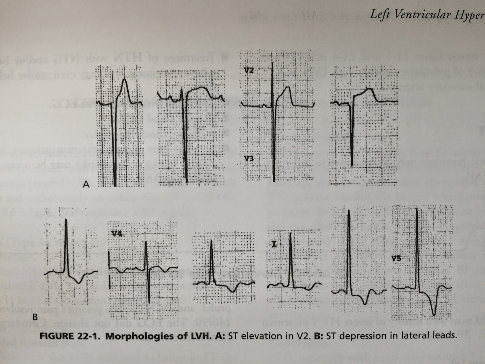 Which Patient should get Acute Cath Lab Activation in MI?
