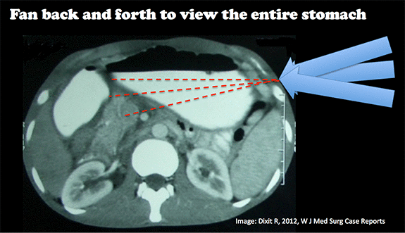 PulmCrit Wee: Ultrasound-guided blakemore tube placement
