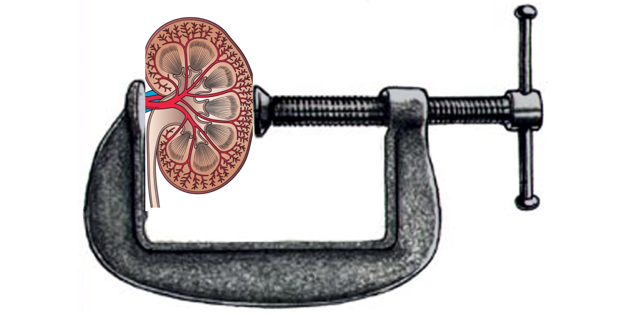 PulmCrit- Killer resuscitation: Abdominal hypertension as an occult ...