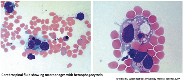 Hemophagocytic LymphoHistiocytosis (HLH) - EMCrit Project
