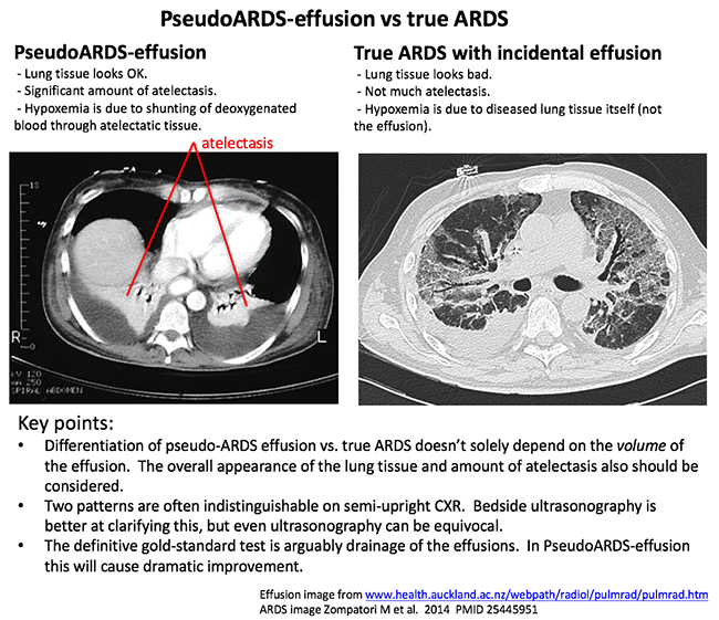 PulmCrit: ARDS vs. pseudoARDS - Failure of the Berlin definition.