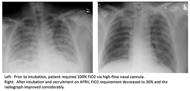 PulmCrit: ARDS vs. pseudoARDS - Failure of the Berlin definition.