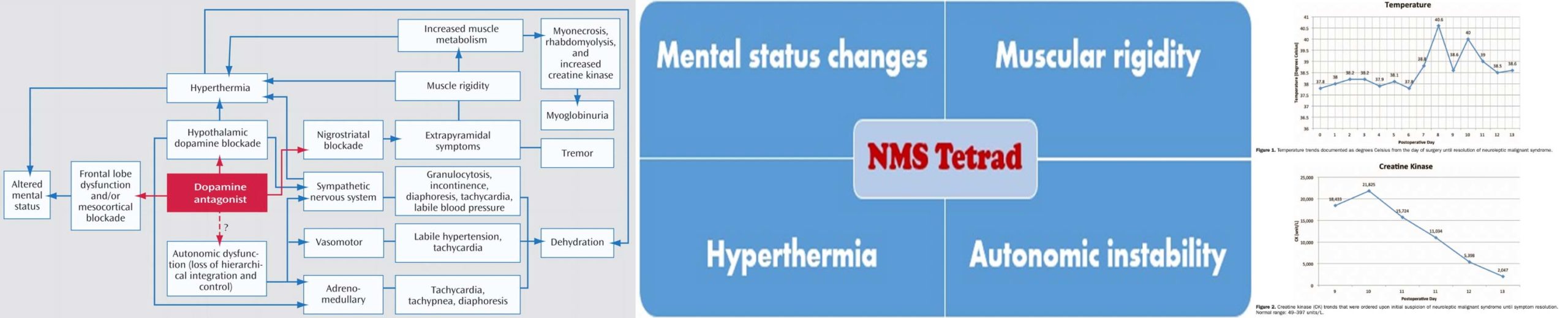 IBCC - Neuroleptic Malignant Syndrome (NMS)