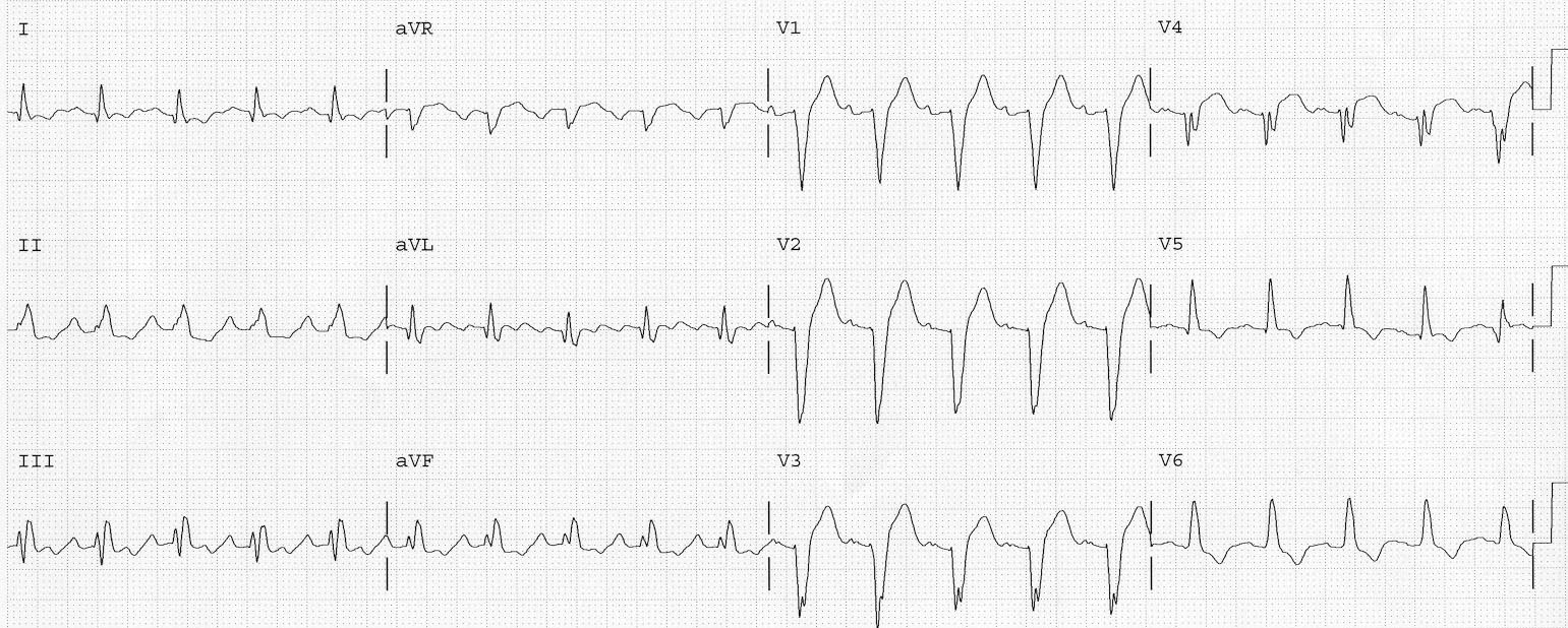 Left Bundle Branch Block doesn't demand the Cath Lab