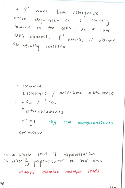 393. What does the ECG show for a PJC? Causes of PVCs and ventricular ...