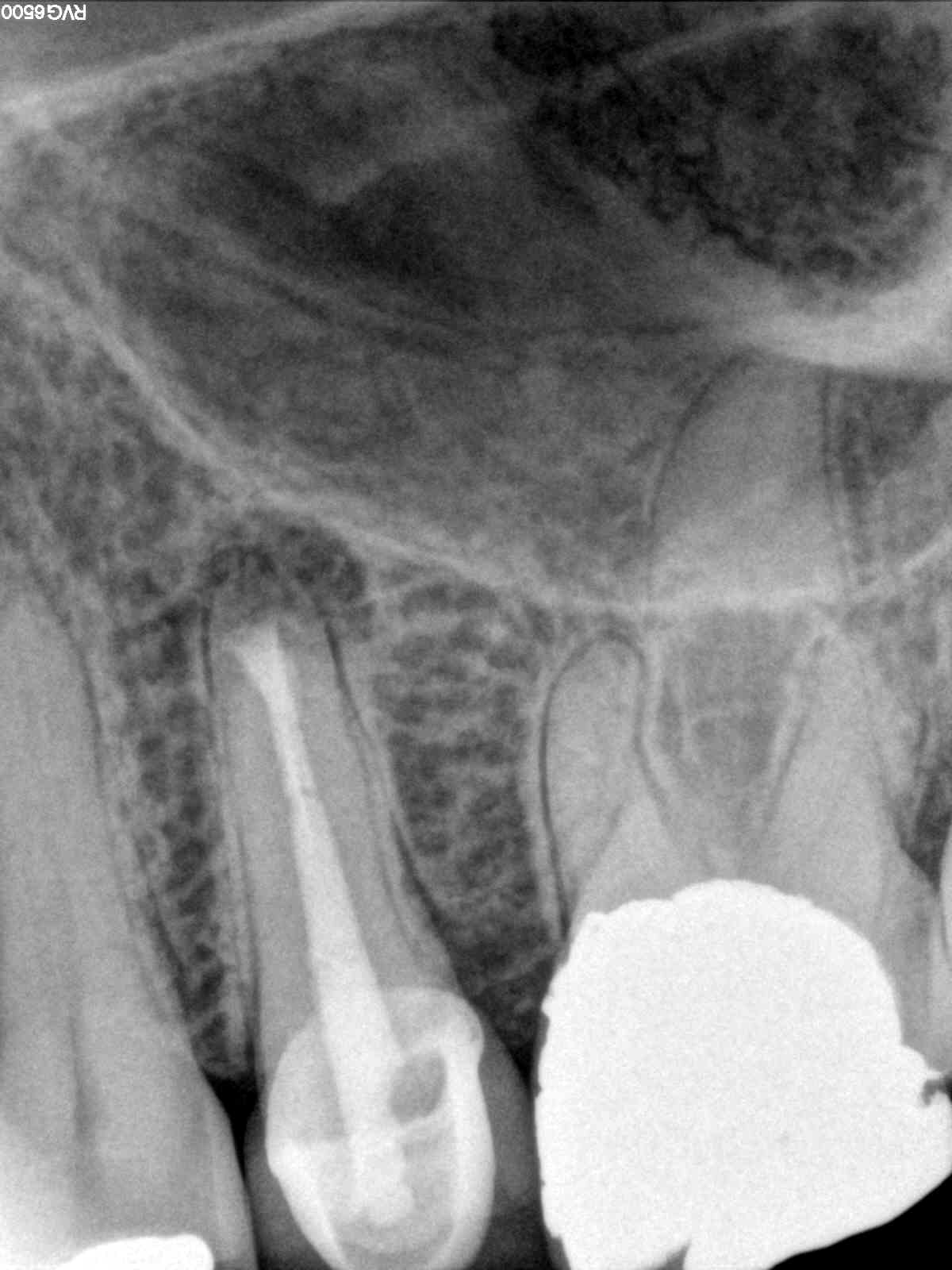 Aetiology of Apical Periodontitis | the endospot