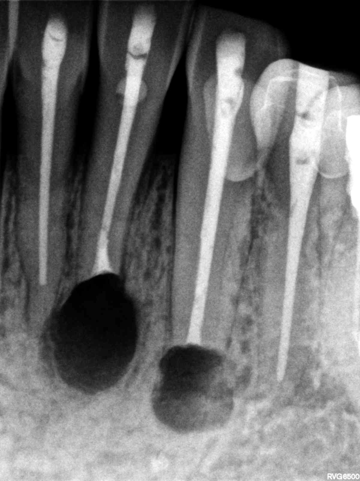 Apicoectomy Failed? Maybe It’s Worth Trying Again. | the endospot