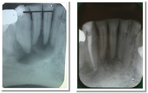 Pulp Testing – An Endodontist’s Best Friend | the endospot