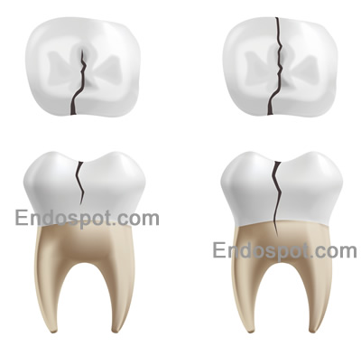 Classifying Cracked Teeth. Operation Complex Part II | the endospot