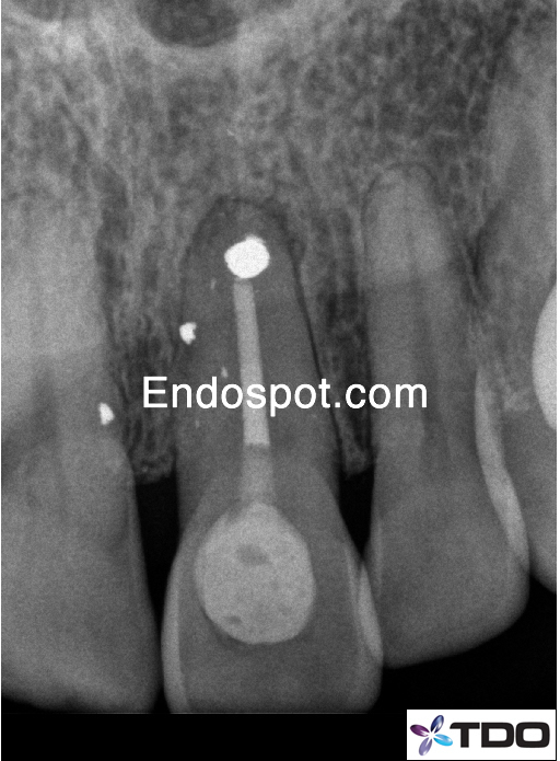 Aetiology of Apical Periodontitis | the endospot