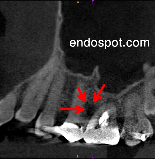 Endodontic Radiography | the endospot