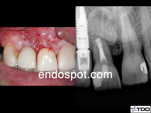 The Compromise. Pre-Implant Apical Surgery. | the endospot
