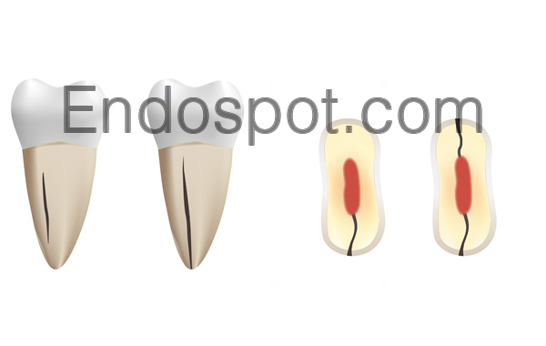 Is it Really a Vertical Root Fracture? | the endospot