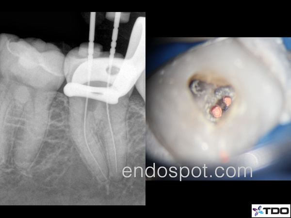 The Lower Second Molar. Tricky in So Many Ways. | the endospot