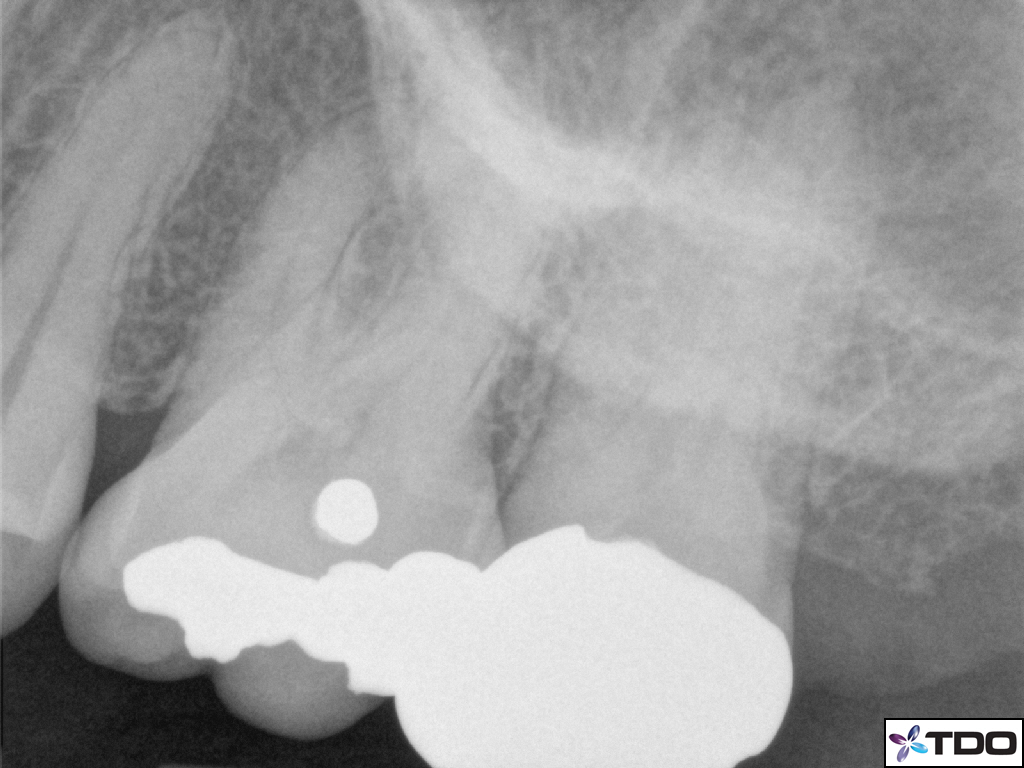 Hamulus Radiograph