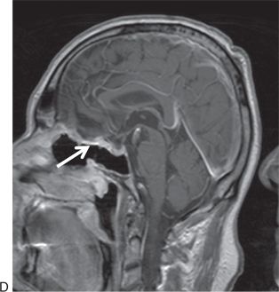 Midfacial Degloving | Ento Key