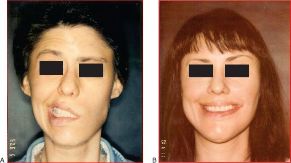 Facial Paralysis | Ento Key