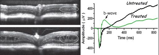 36 Visual Prostheses | Ento Key