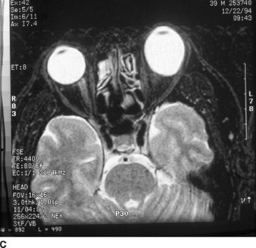 51 Treatment of High Myopia | Ento Key