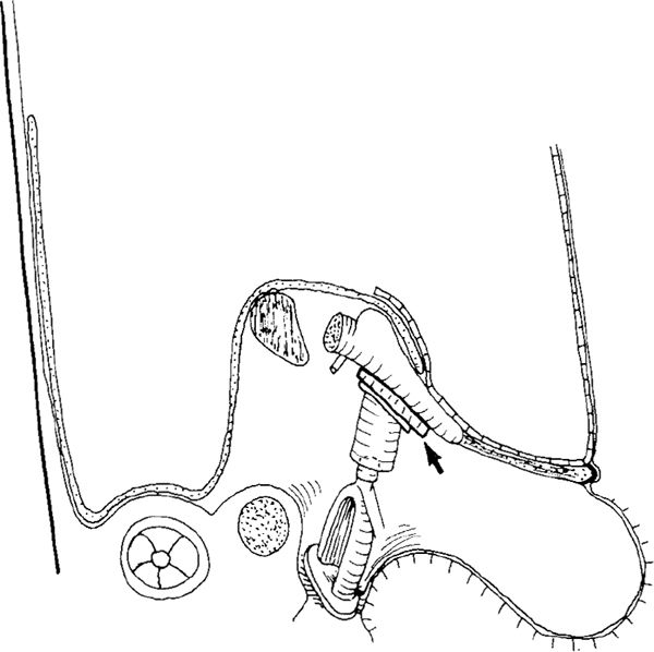 Endaural Canal Wall-Down Mastoid Surgery | Ento Key