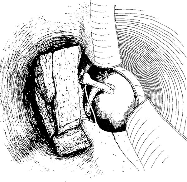 Reconstruction of the Posterior Ear Canal Wall | Ento Key