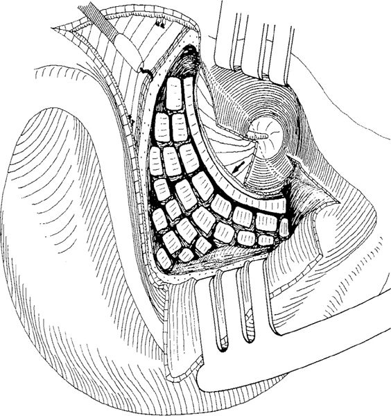 Cavity Obliteration with Cartilage | Ento Key