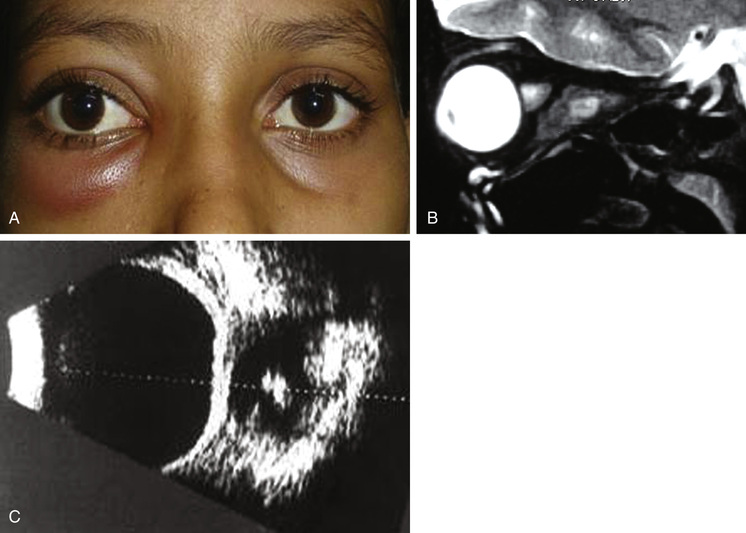 Infections of the Orbit and Ocular Adnexa | Ento Key