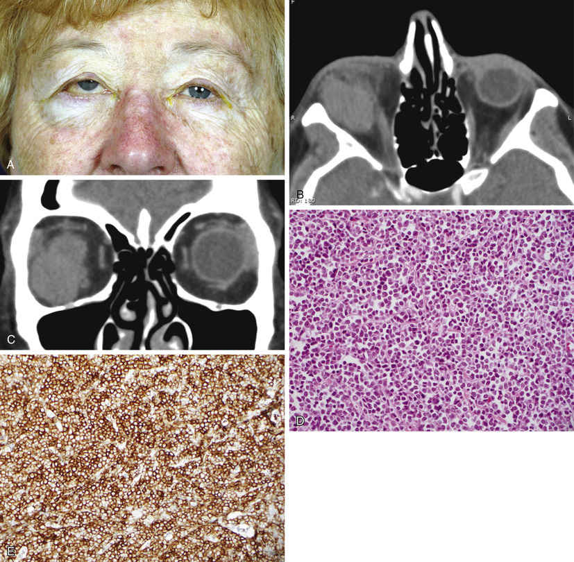 Fat, Fibrous, Muscle, and Other Mesenchymal Tumors of the Orbit | Ento Key