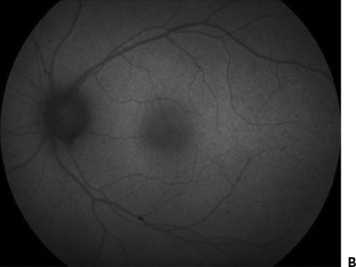 Normal Anatomy of the Macula | Ento Key