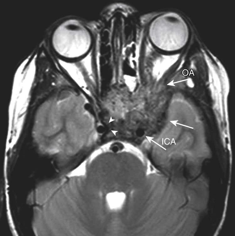 Rhinology and Endoscopic Sinus Surgery | Ento Key
