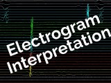 Electrogram Interpretation 15 Ep Essentials