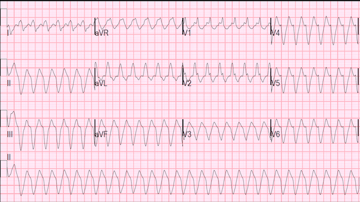 ECG Quiz: Very Wide and Very Fast | Emergency Physicians Monthly