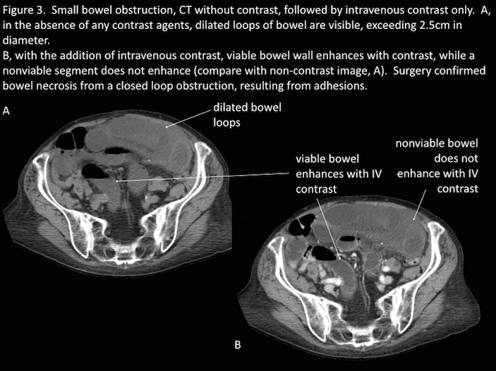 CT of Small Bowel Obstruction | Emergency Physicians Monthly