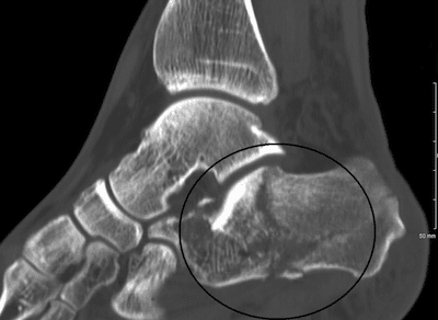 Trauma Pearl – Calcaneal Crunchie | Emergency Trauma Management