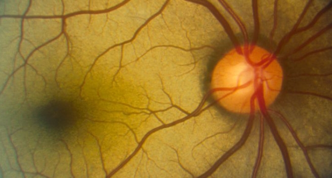 Fundus Imaging | EYE-PIX