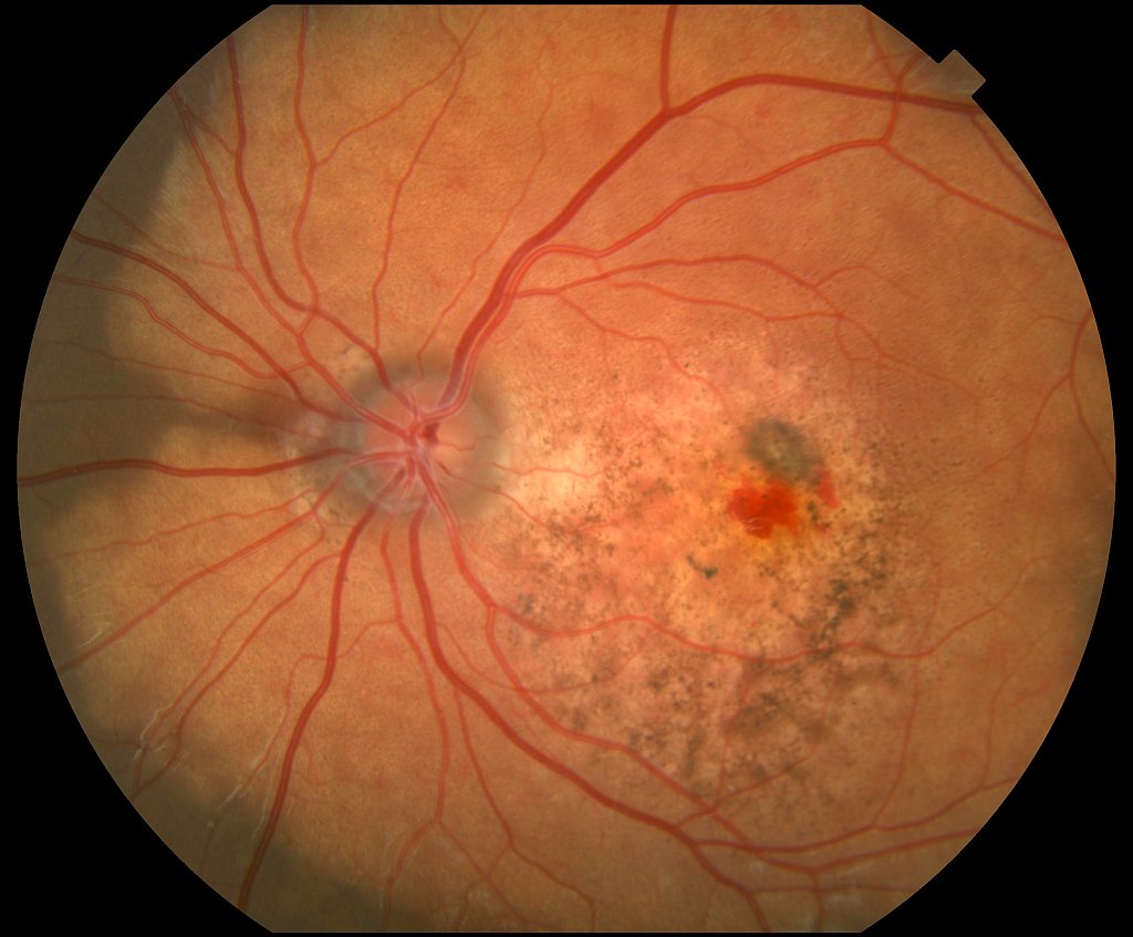 Choroidal Osteoma | EYE-PIX