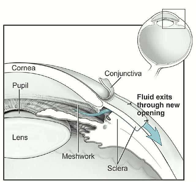 CyPass® Micro-Stent - A New Solution For Glaucoma By Alcon - Eye Bulletin